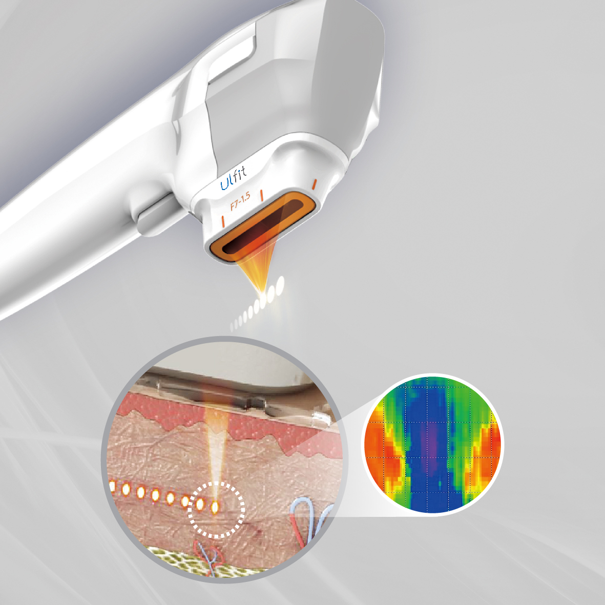 2025專業HIFU: Ulfit